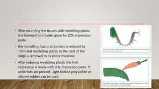Functional impression in RPD | PPTX