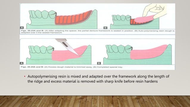 Functional impression in RPD | PPTX | Dental Health | Diseases and ...