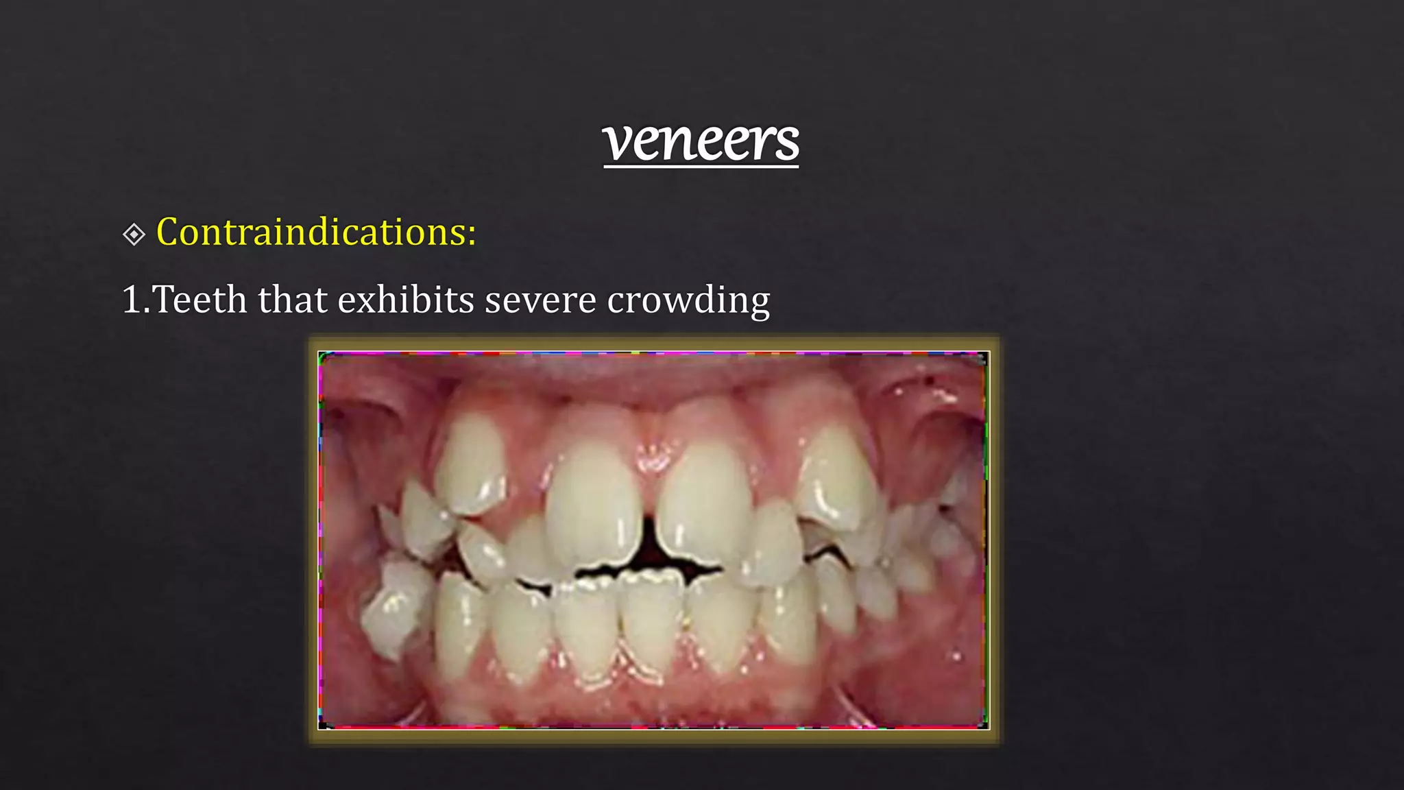 Veneers ,indications,teeth Preperation for veneers | PPT | Free Download