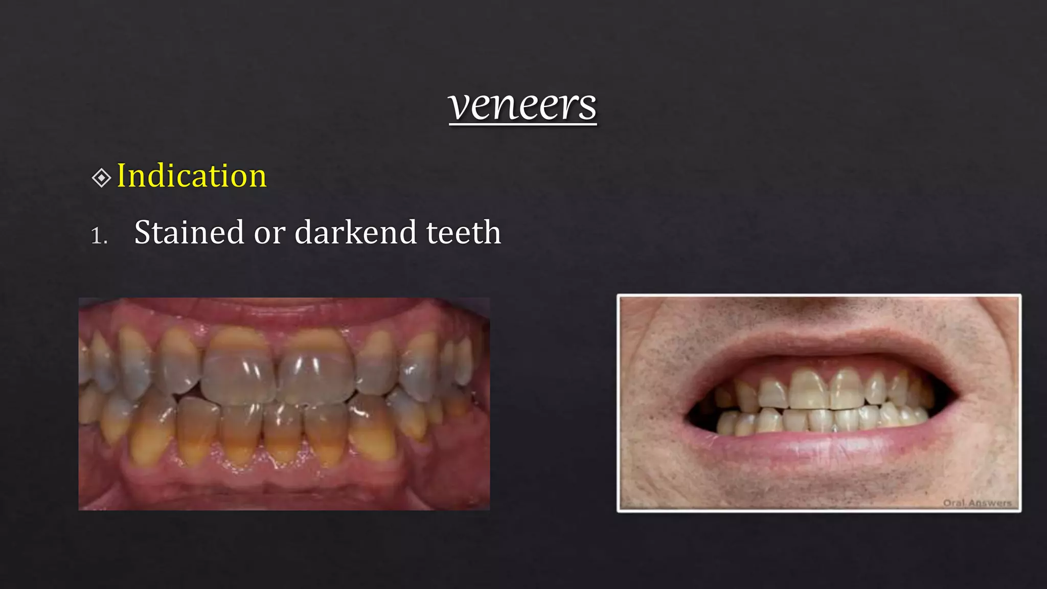 Veneers ,indications,teeth Preperation for veneers | PPT | Free Download