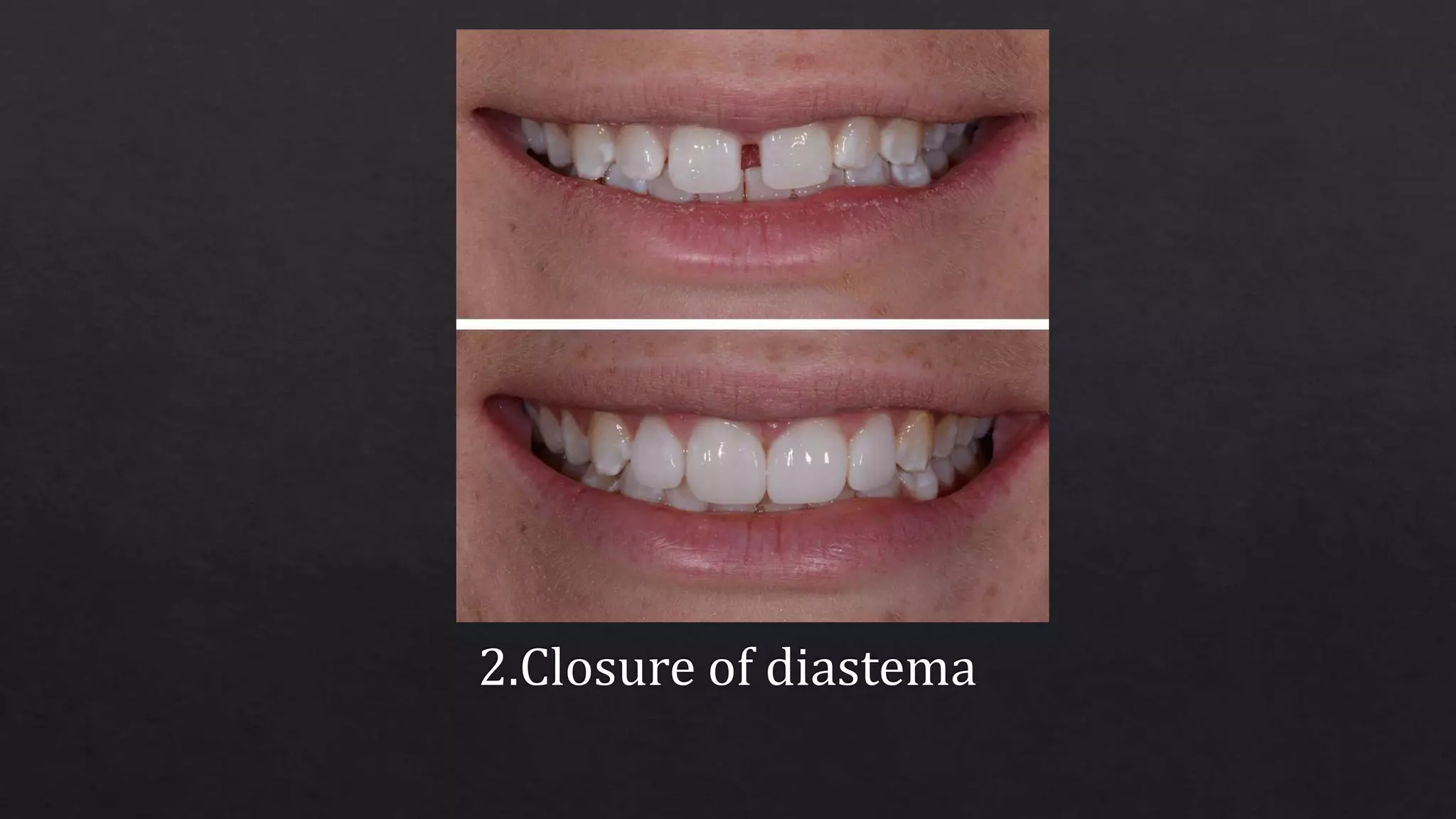 Veneers ,indications,teeth Preperation for veneers | PPT | Free Download