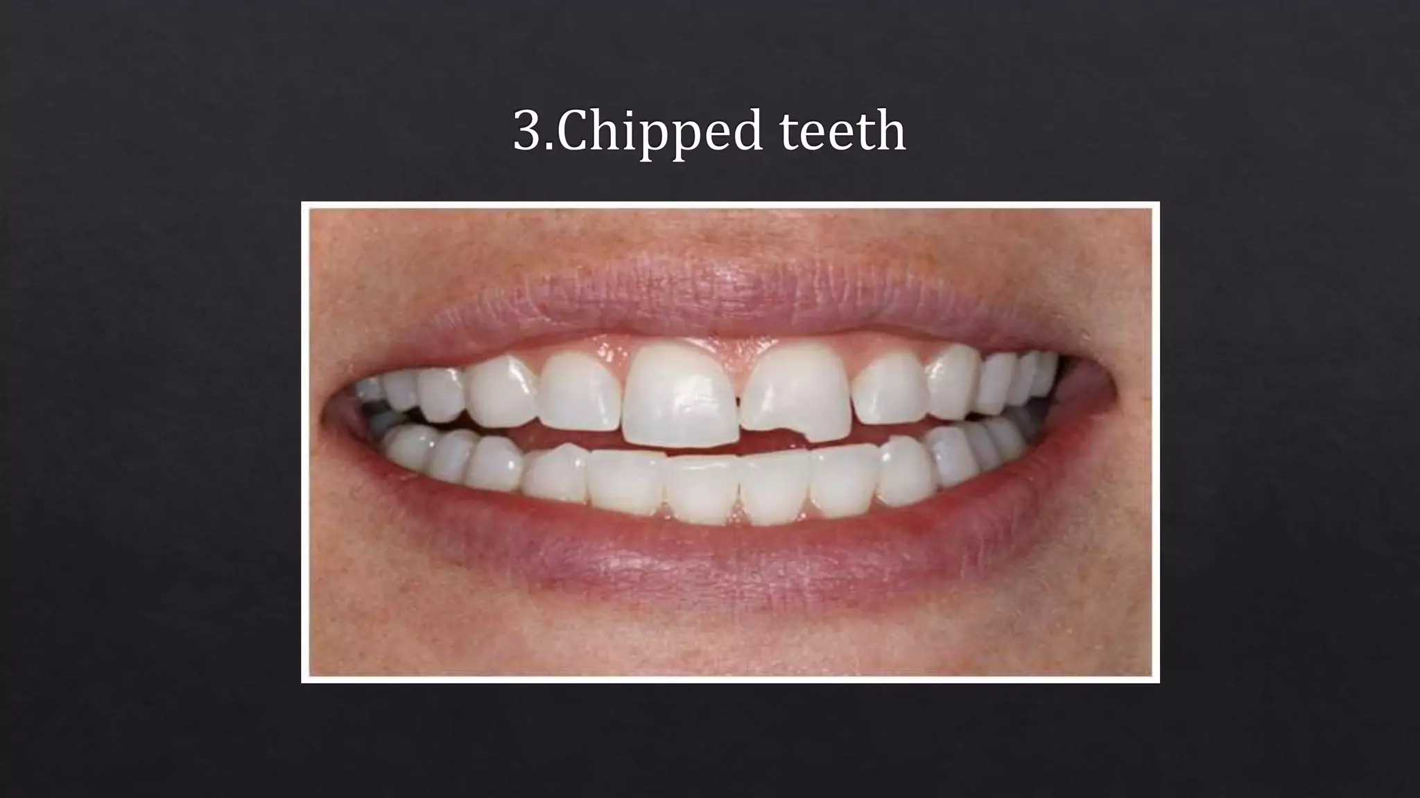 Veneers ,indications,teeth Preperation for veneers | PPT | Free Download