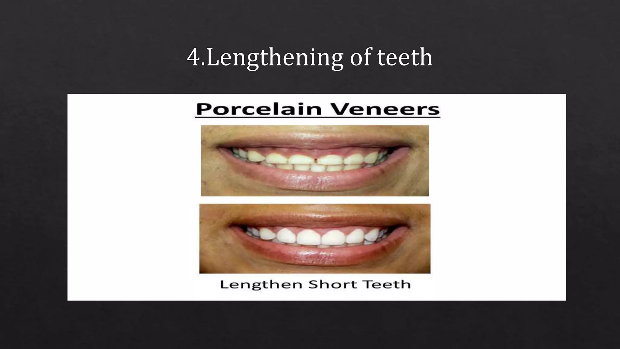 Veneers ,indications,teeth Preperation for veneers | PPT