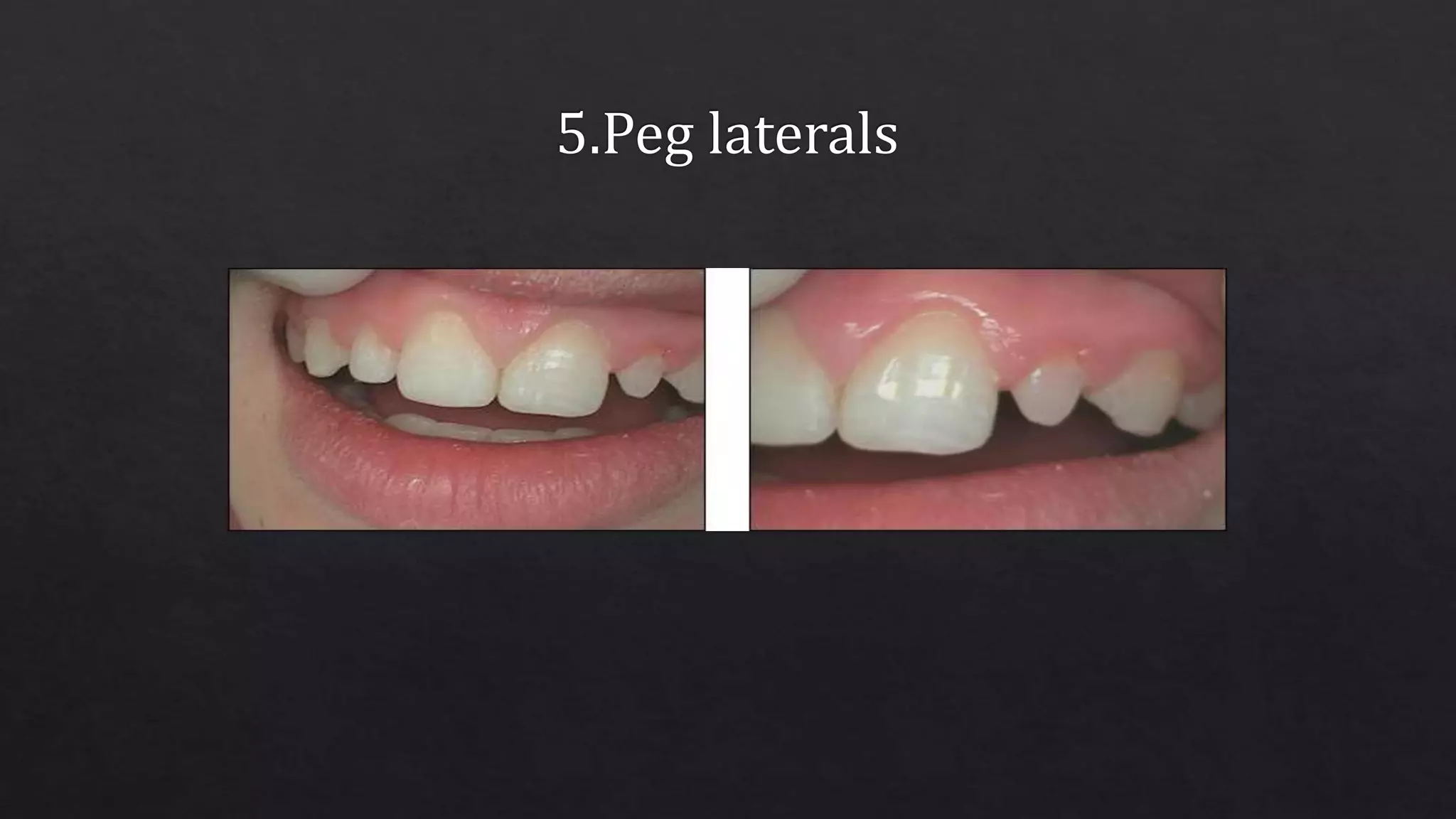 Veneers ,indications,teeth Preperation for veneers | PPT
