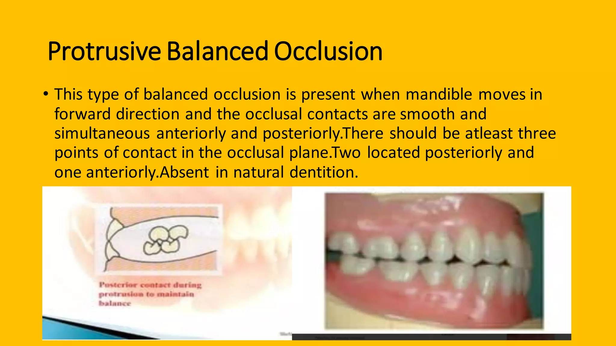 BALANCED OCCLUSION | PDF