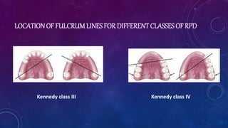 Indirect retainer and minor connector.pptx