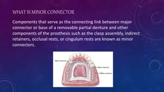 Indirect retainer and minor connector.pptx