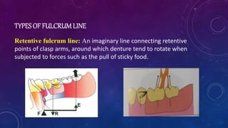 prostho seminar.pptx