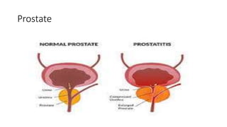 A lecture slide on Prostitis.pptx for nursing students | PPTX