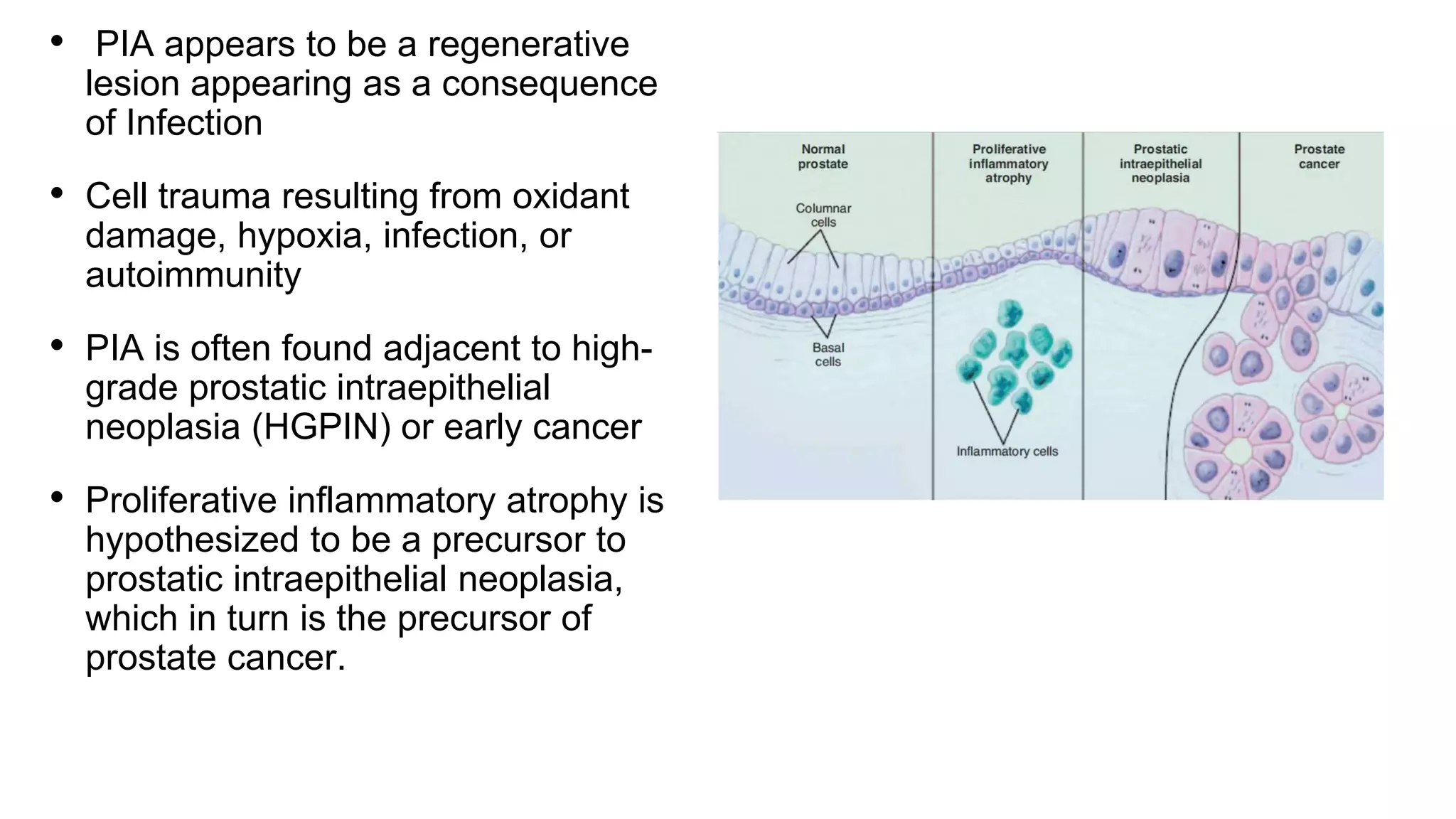Carcinoma Prostate: etiopathogenesis and staging- 2022 guidelines | PPTX