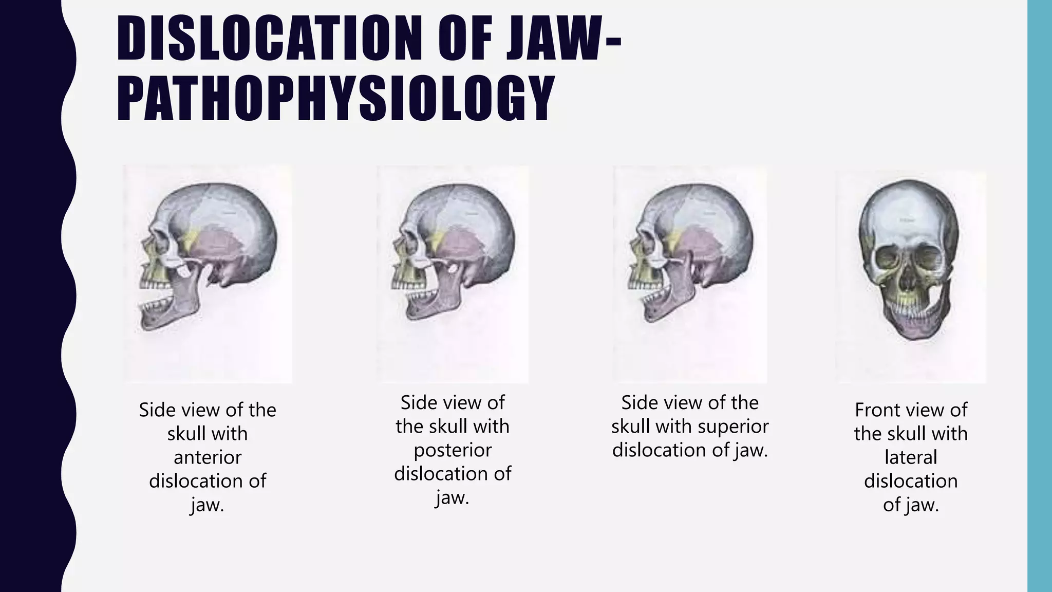 TMJ- Temporomandibular joint | PPT