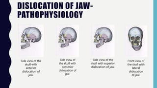TMJ- Temporomandibular joint | PPT
