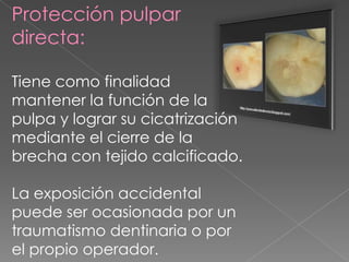 ProteccióN Dentino Pulpar | PPTX