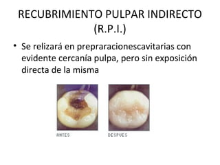 Proteccion pulpar | PPT