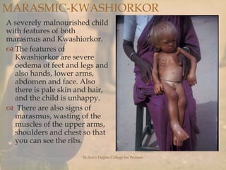 Protein Energy Malnutrition | PPTX