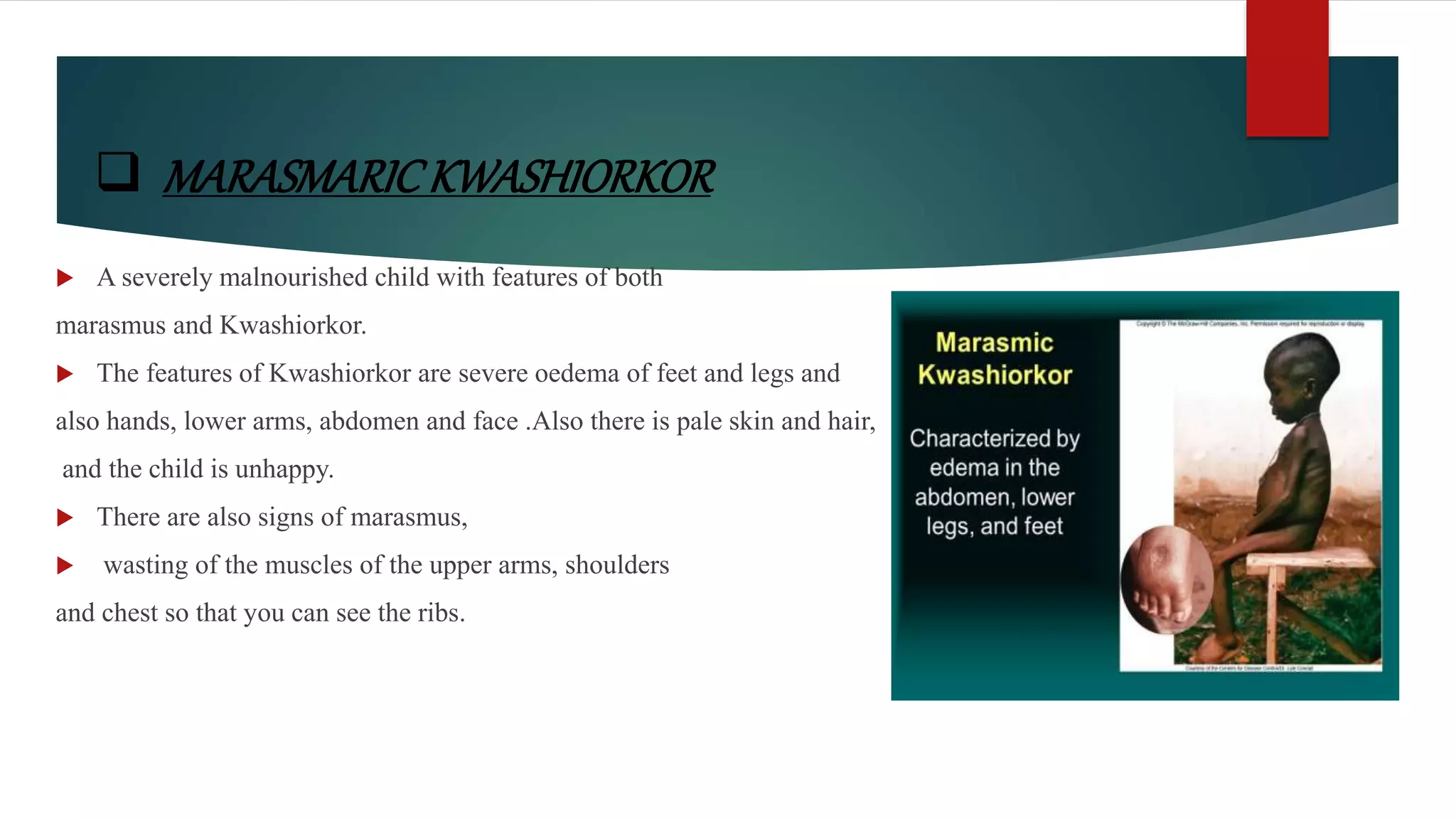 Protein calorie malnutrition | PPTX