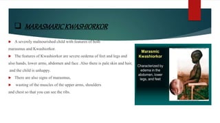 Protein calorie malnutrition | PPTX