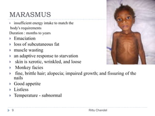 Protein energy malnutrition | PPTX