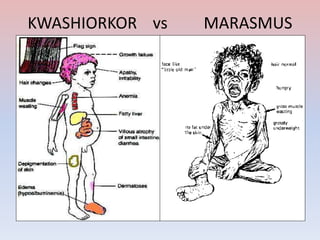 Protein energy malnutrition | PDF