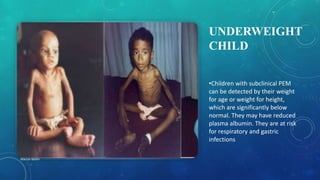 Protein energy malnutrition | PPT