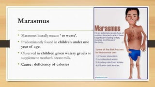 Protein energy malnutrition | PPT