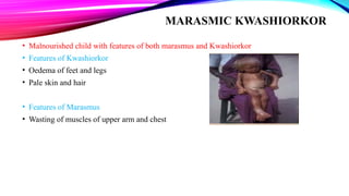 Protein Energy Malnutrition and types-.pptx