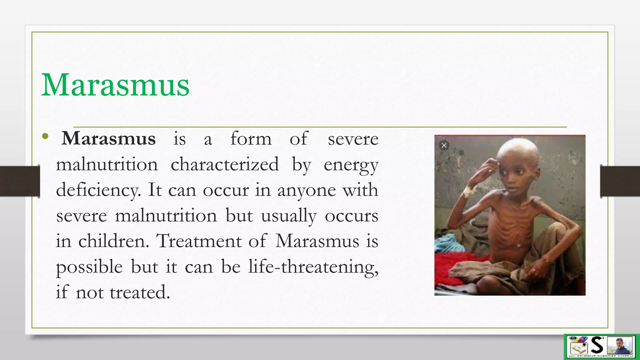Protein energy malnutrition in children english | PPTX