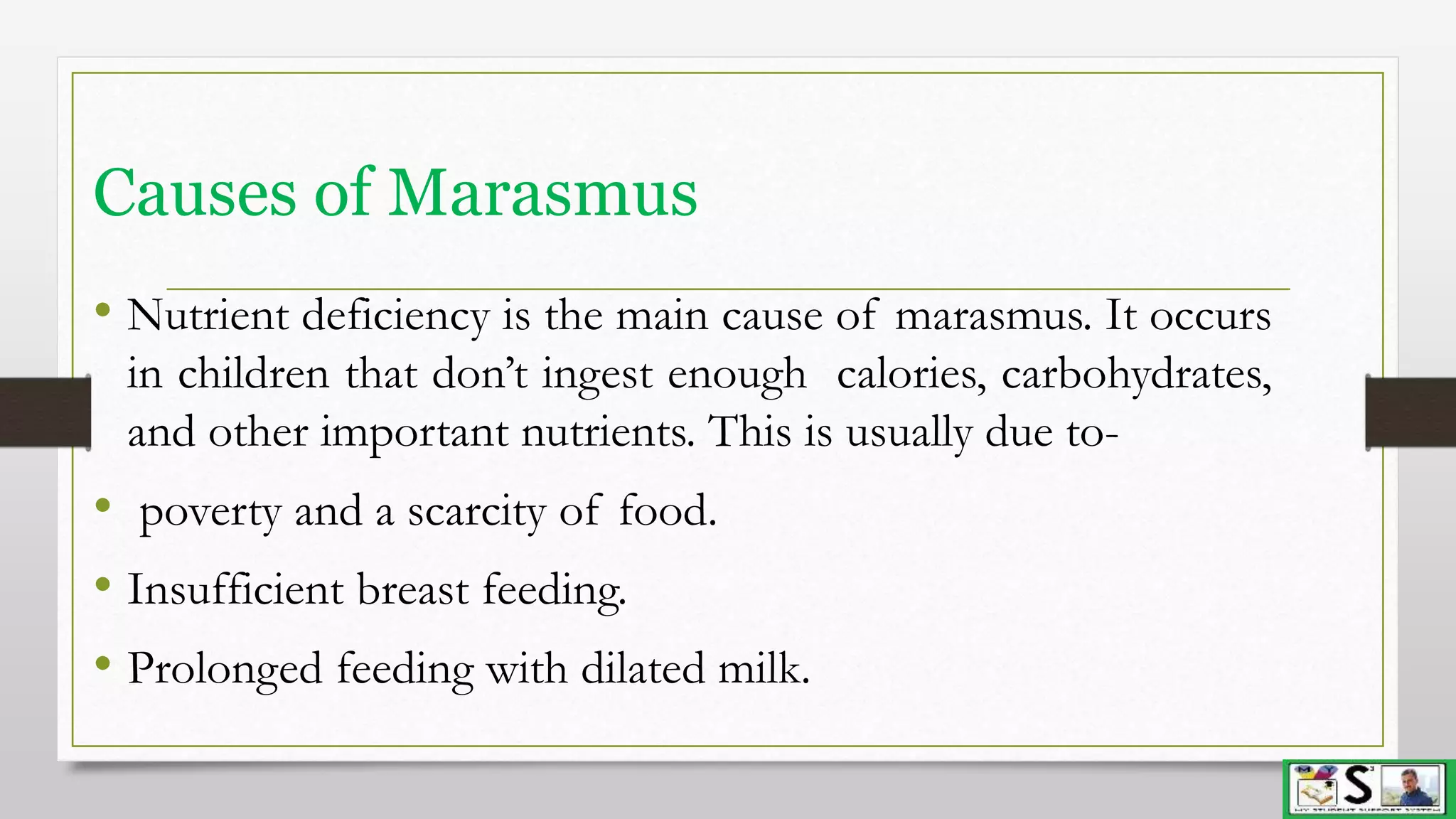 Protein energy malnutrition in children english | PPTX