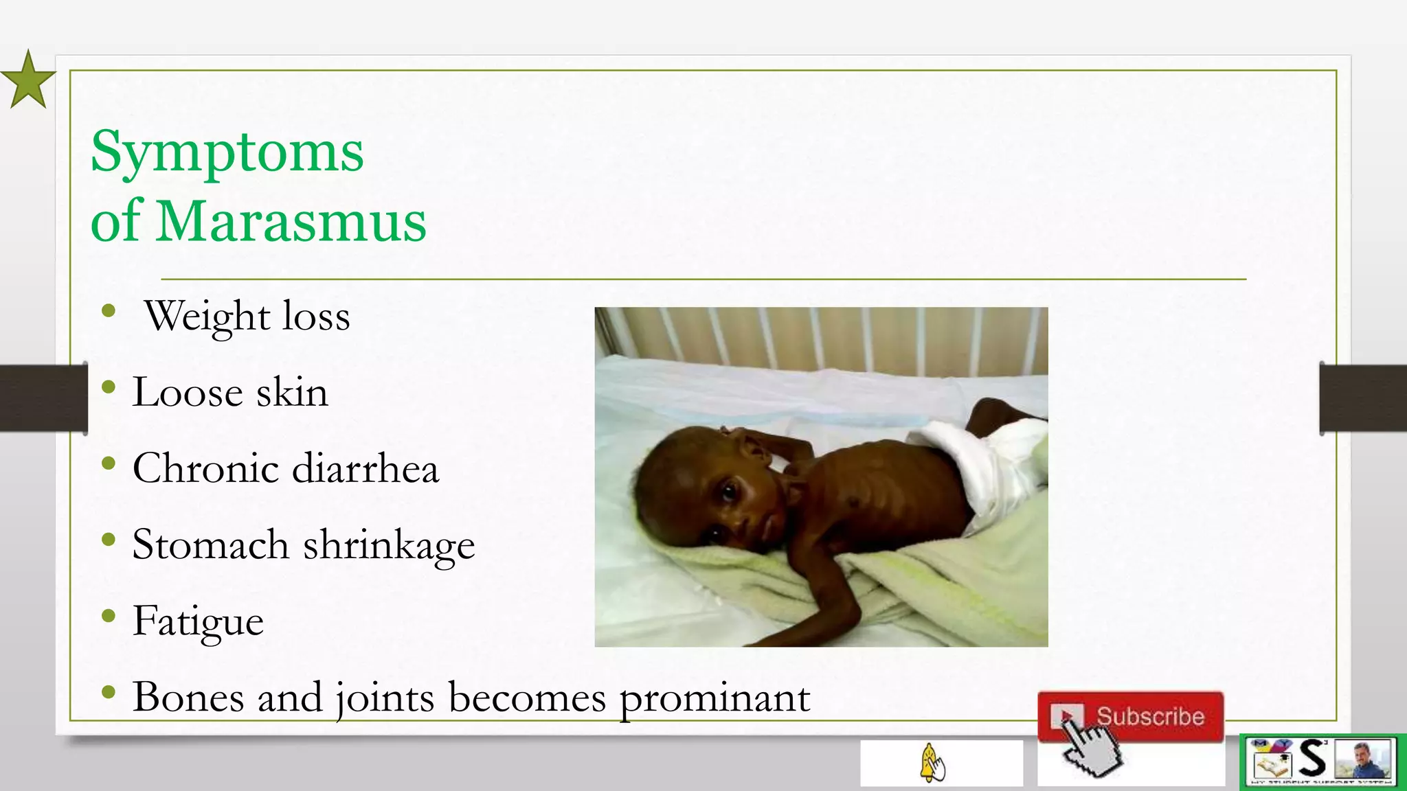 Protein energy malnutrition in children english | PPTX