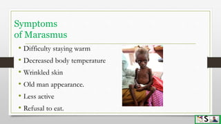Protein energy malnutrition in children english | PPTX