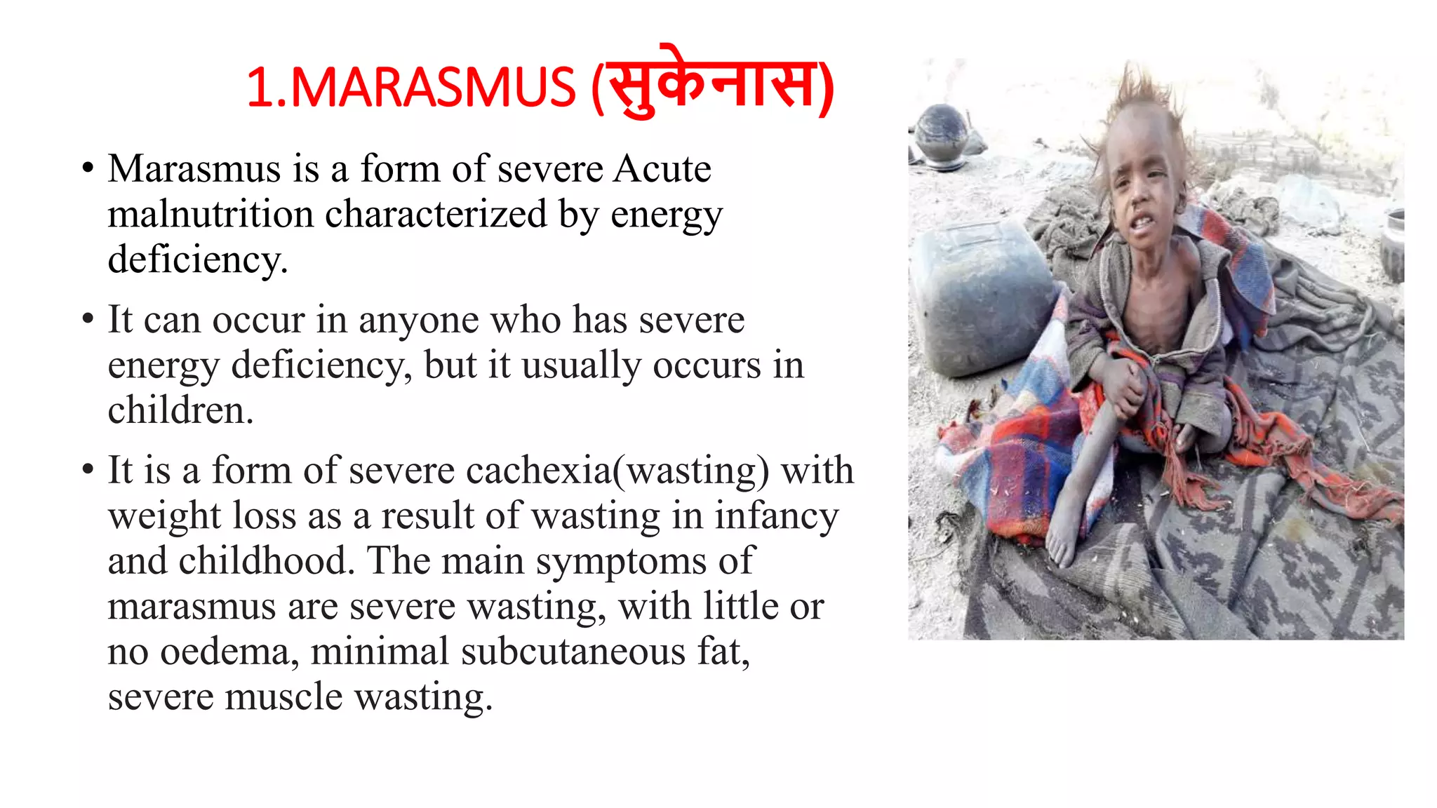 Protein Energy Malnutrition (nepal).pptx