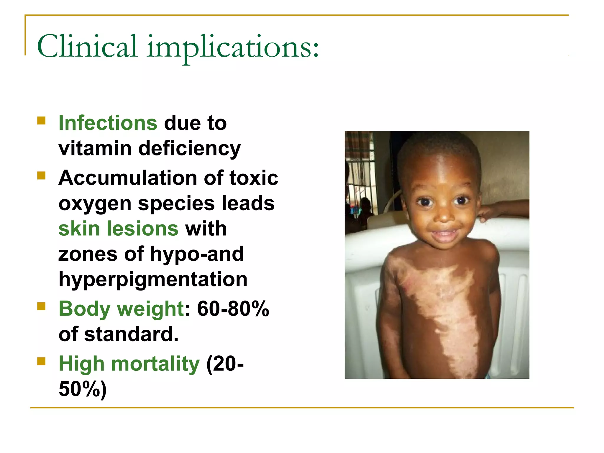 Protein Energy Malnutrition(PEM) | PPT