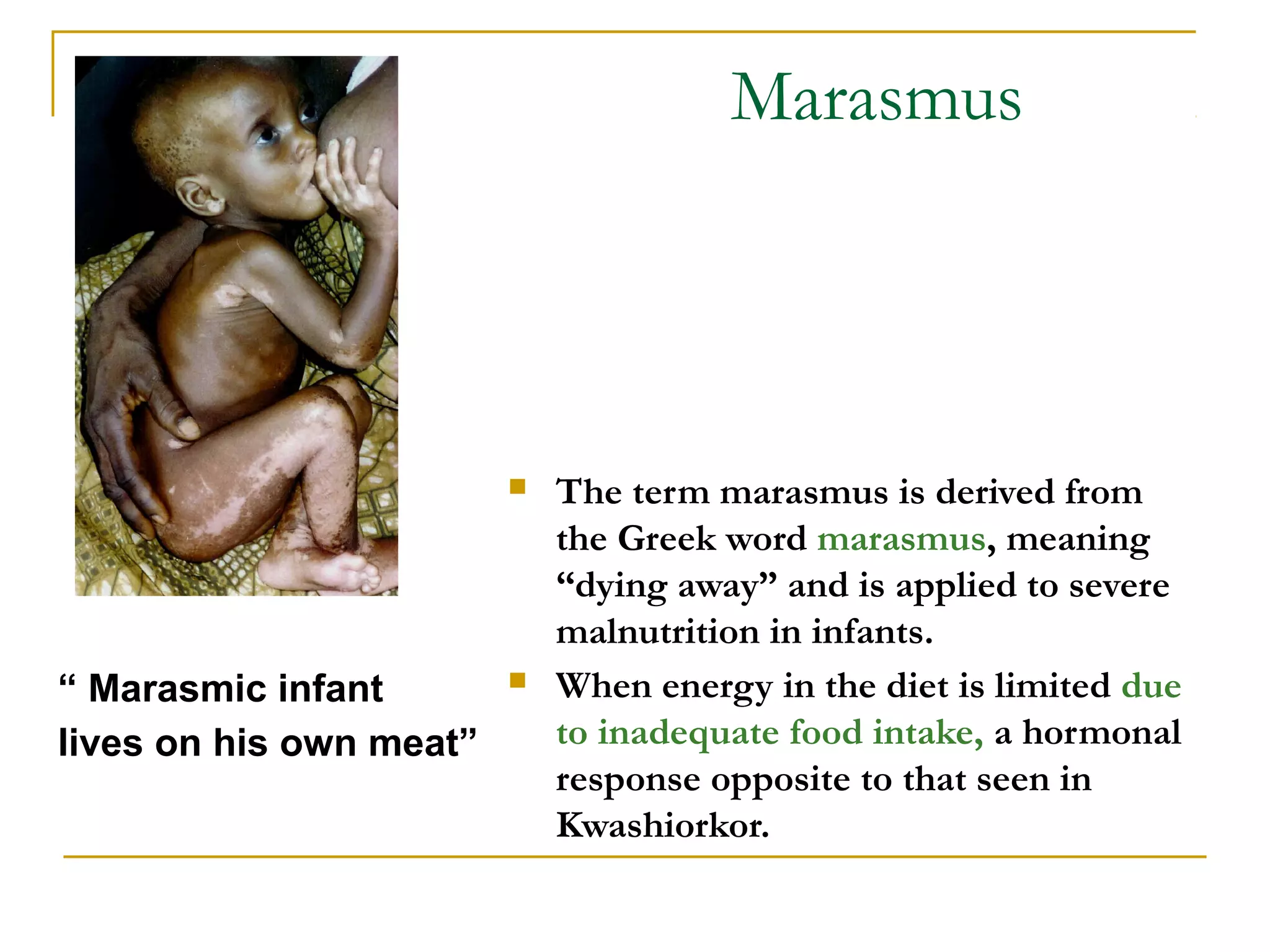 Protein Energy Malnutrition(PEM) | PPT
