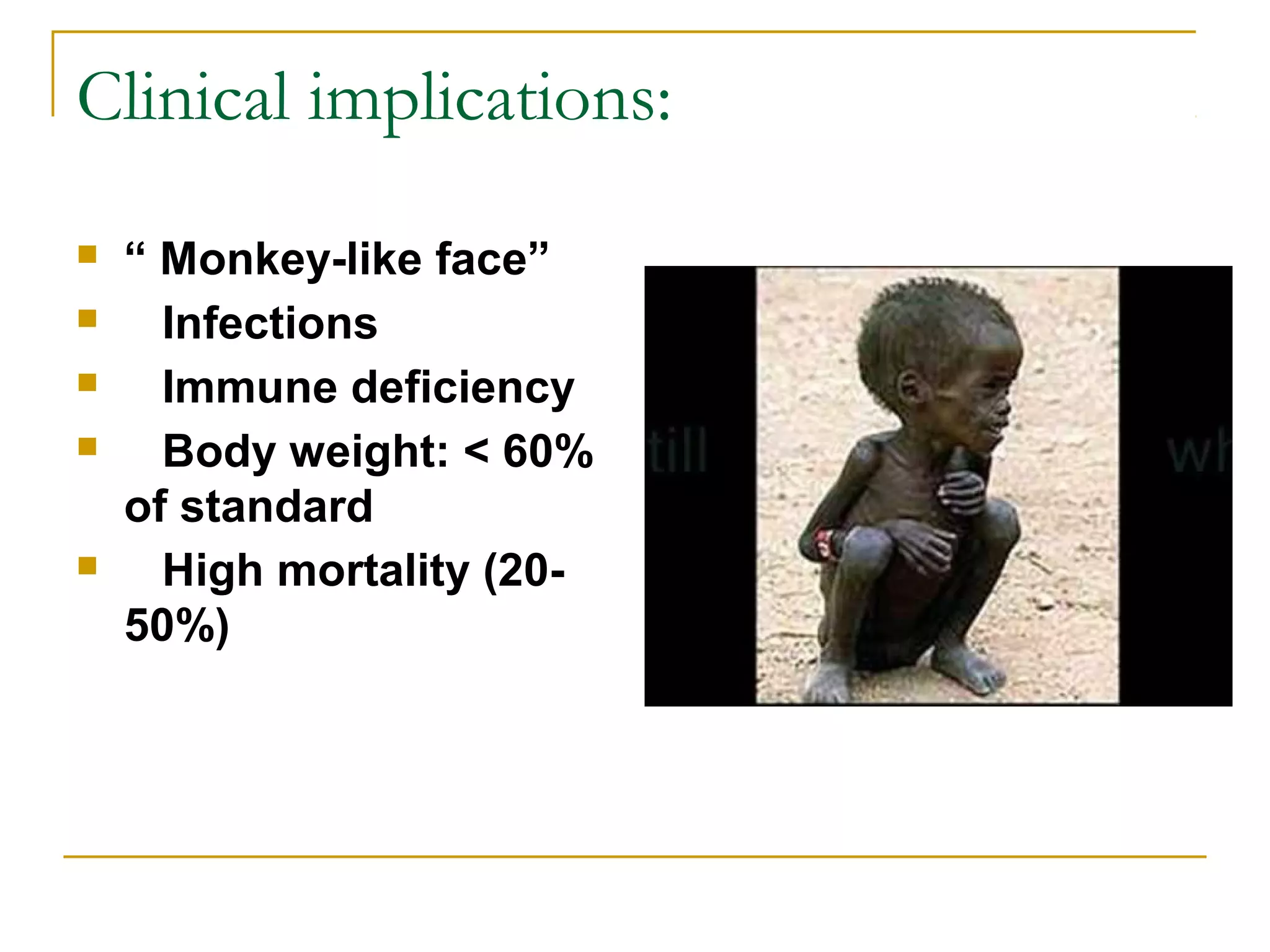Protein Energy Malnutrition(PEM) | PPT