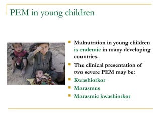 Protein Energy Malnutrition(PEM) | PPT