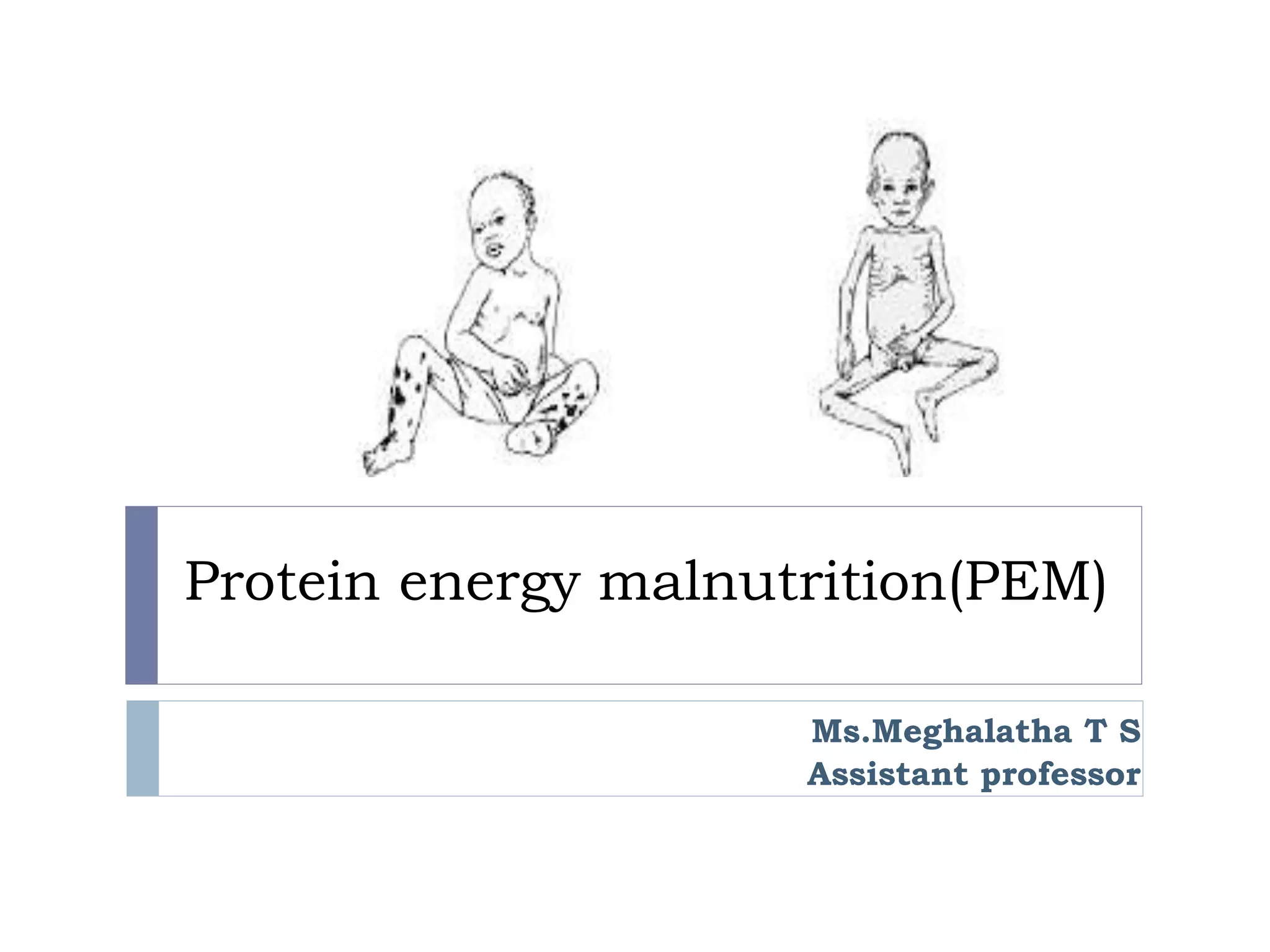 Protein energy malnutrition(PEM) | PPTX