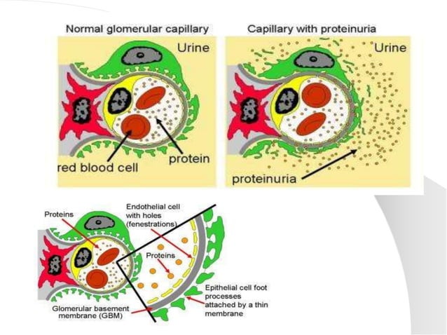Proteinuria and paraproteinemias | PPTX | Biological Sciences | Science
