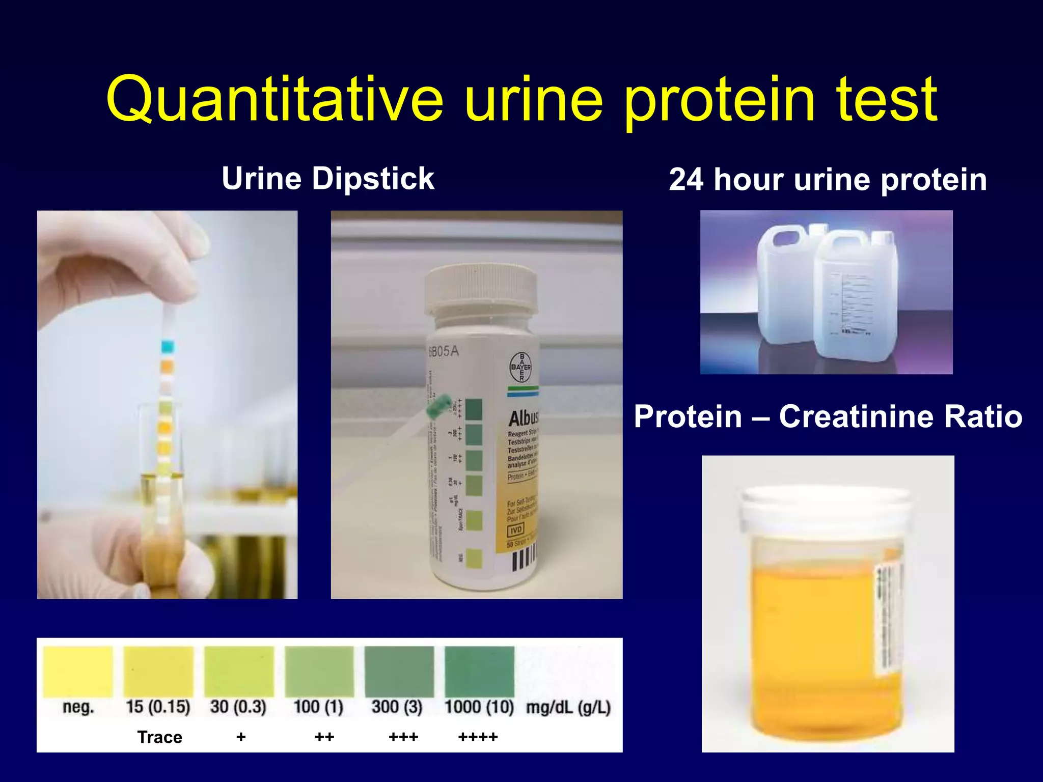 APPROACH TO PROTEINURIA | PPTX