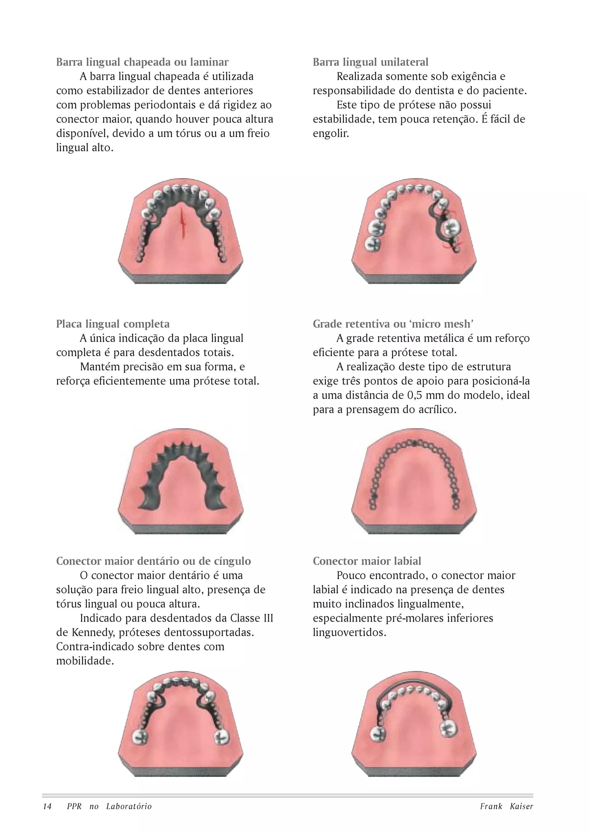 Prótese Parcial Removível Odontológico | PDF