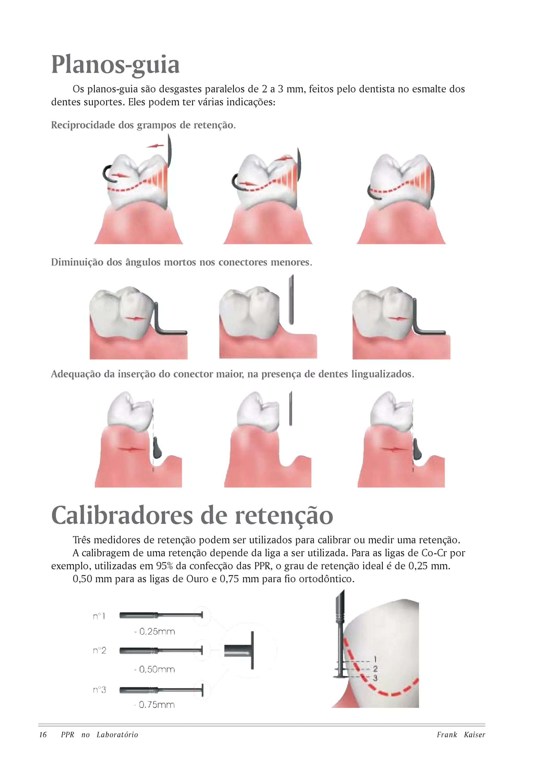 Prótese Parcial Removível Odontológico | PDF