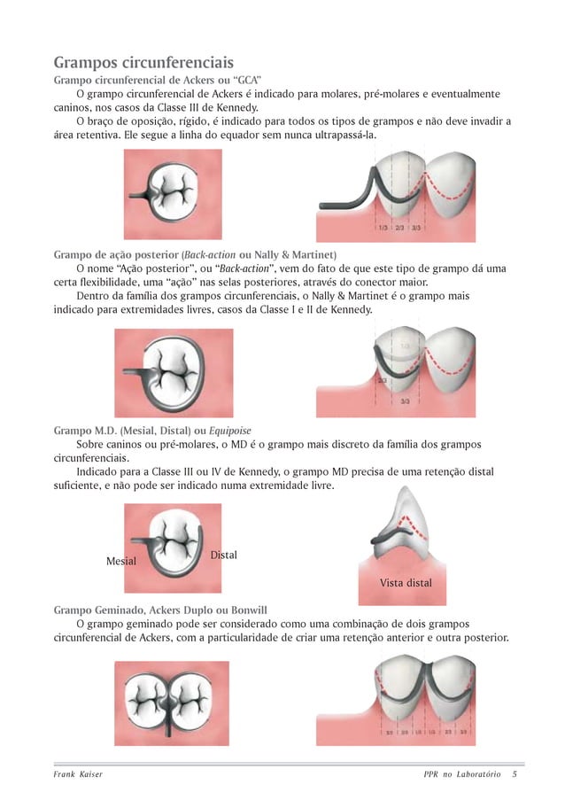 Prótese Parcial Removível Odontológico | PDF