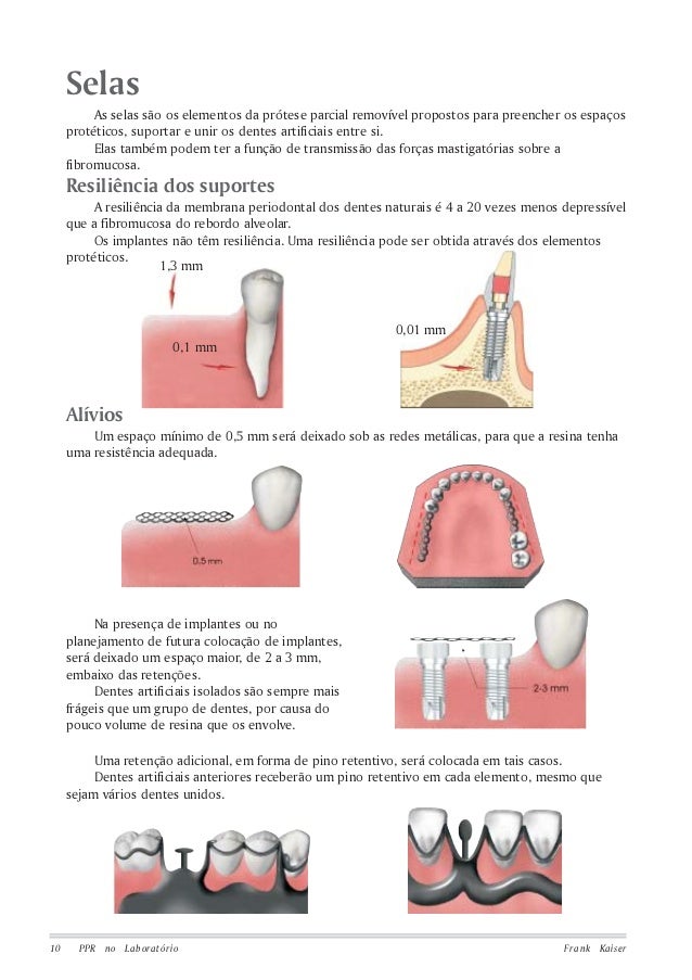 Prótese Parcial Removível Odontológico