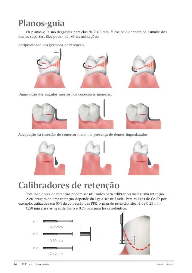 Prótese Parcial Removível Odontológico