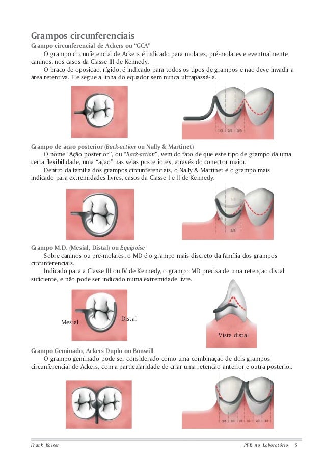 Prótese Parcial Removível Odontológico