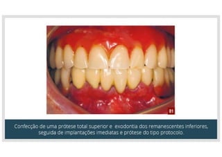 Prótese Total Fixa | PDF