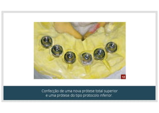 Prótese Total Fixa | PDF