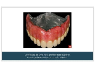 Prótese Total Fixa | PDF