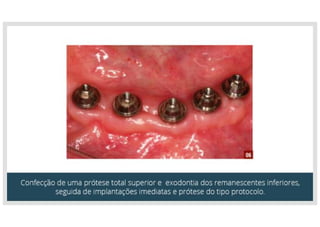 Prótese Total Fixa | PDF