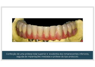 Prótese Total Fixa | PDF