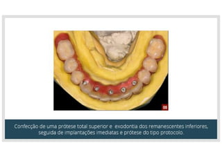 Prótese Total Fixa | PDF